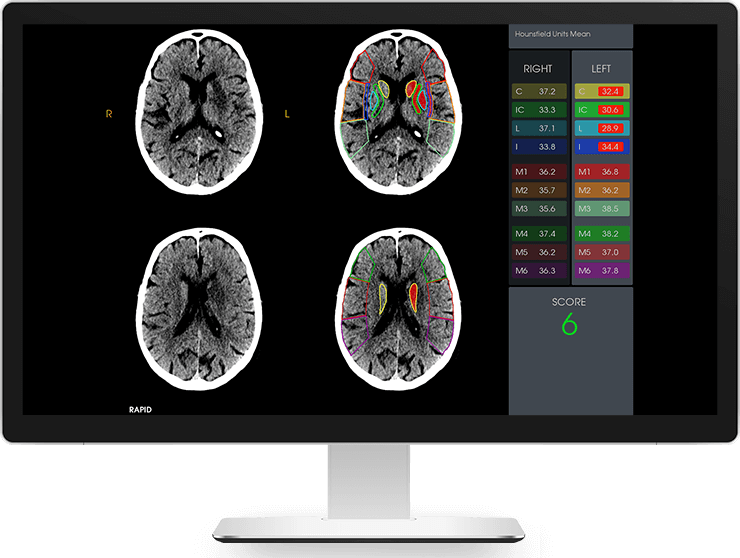 New RapidAI Software Enhances Lifesaving Stroke Treatment | Kettering ...