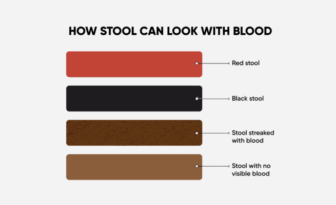 What Blood in Your Stool Could Mean | Kettering Health