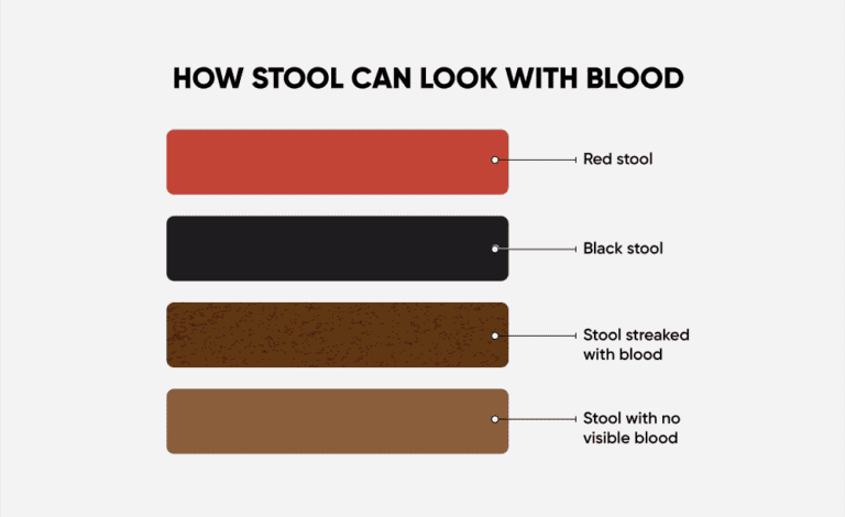 What Blood in Your Stool Could Mean | Kettering Health